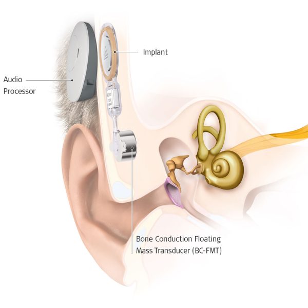 Bone & Cochlear Implants - Bundaberg Hearing