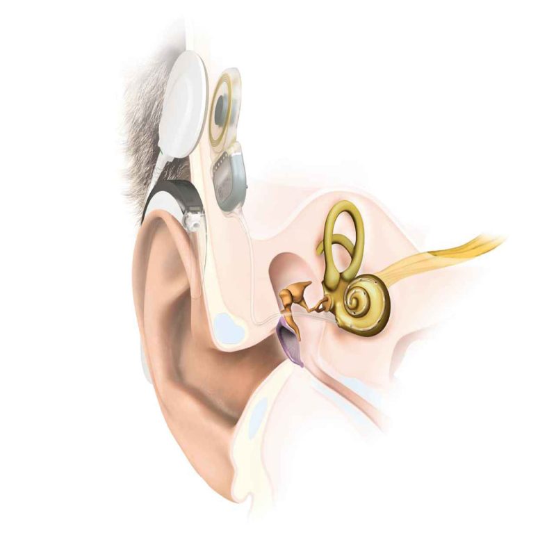 Bone & Cochlear Implants - Bundaberg Hearing